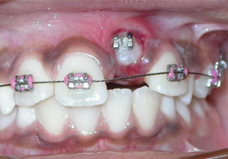 Impacted Front Teeth