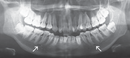 Mandibular Foramen Radiograph