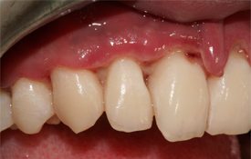 Managing Patients with Necrotizing Ulcerative Gingivitis | jcda